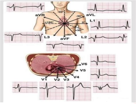 Pcmii Ekg Lecture 1 Flashcards Quizlet