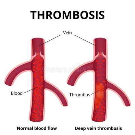 Thrombus Formation Stock Vector Illustration Of Anatomical 109182205