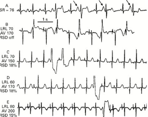 Prevention Of Torsade De Pointes In The Congenital Long Qt Syndrome