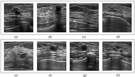 The Samples Of Benign And Malignant Tumors Images That Were Incorrectly