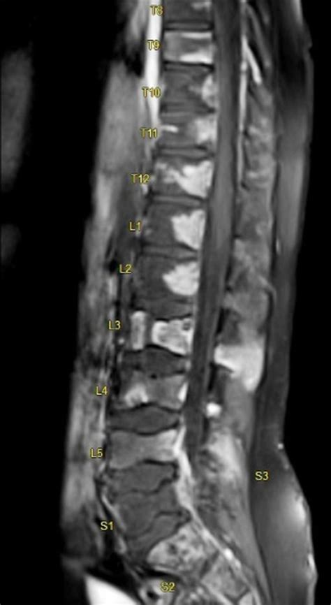 Post Contrast Saggital Magnetic Resonance Imaging Mri Picture Of The