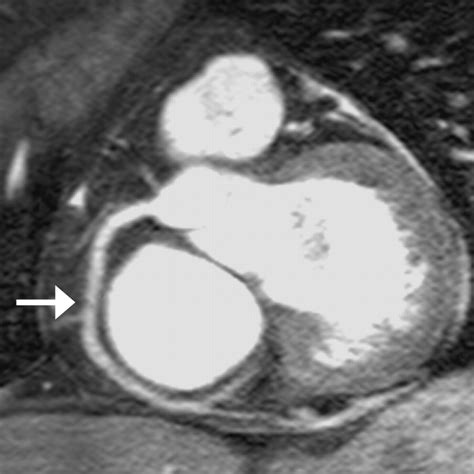 Comparison Of 3d Segmented Gradient Echo And Steady State Free