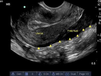 Point Of Care Ultrasound Diagnosis Of A Ruptured Live Ectopic Pregnancy