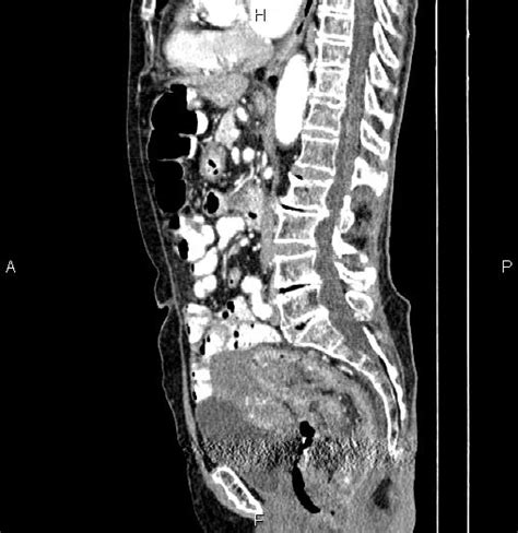 Rectosigmoid Intussusception Due To Tumoral Infiltration Image