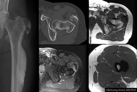 Roentgen Ray Reader Melorheostosis