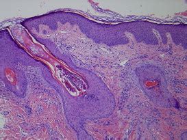 Unilateral Keratosis Pilaris Atrophicans Faciei Mimicking Follicular