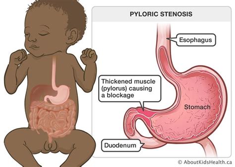 A 6 Week Old Infant With Pyloric Stenosis Is Scheduled Fo Nursing Exam