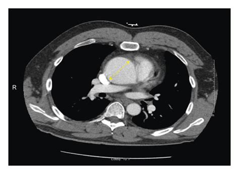 Ct Chest With Contrast Showing 6 Cm Aortic Root Yellow Dotted Line
