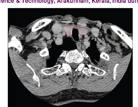 Figure 1 From Thyroid Segmentation And Volume Estimation Using Ct