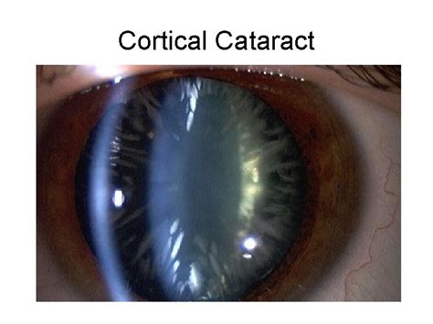 Diabetic Eye Disease Not Just Retinopathy Eye Anatomy