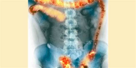 9 People Describe How They Were Diagnosed With Ulcerative Colitis Self