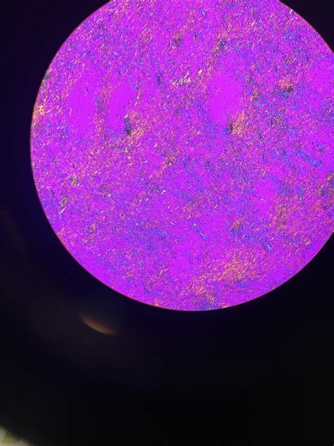 Synovial Fluid Collected From Elbow R Medlabprofessionals