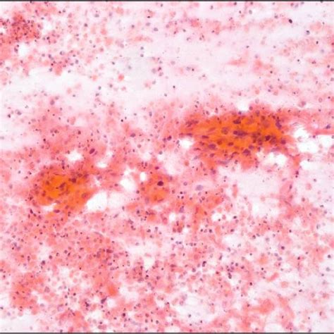 Microscopic View Of Aspirated Specimen Malignant Squamous Cells With