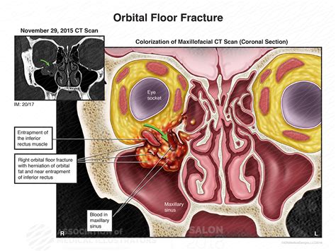 Types Of Orbital Floor Fractures