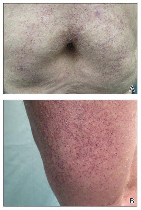 Cutaneous Collagenous Vasculopathy Mdedge Dermatology