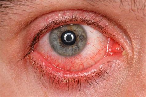 What Is A Posterior Capsulotomy And How Does It Work The Eye News