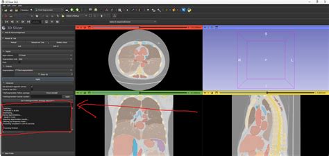 Problem With Totalsegmentator Support 3d Slicer Community