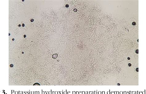 Generalized Tinea Versicolor Following Initiation Of Ixekizumab Therapy
