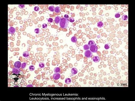 Solution Hematology Myeloproliferative Disorder Studypool
