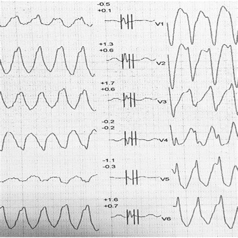 Electrocardiogram During Peak Treadmill Test Showed Wide Qrs‐complex Download Scientific