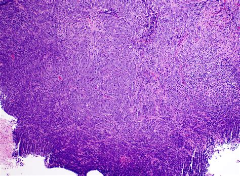 Pathology Outlines Nasopharyngeal Carcinoma
