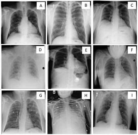 Optimal And Suboptimal Chest X Rays A Optimal Quality Chest X Ray