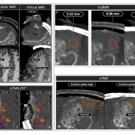 Intraoperative Brain Imaging And Brain Shift Correction Bsc A Download Scientific