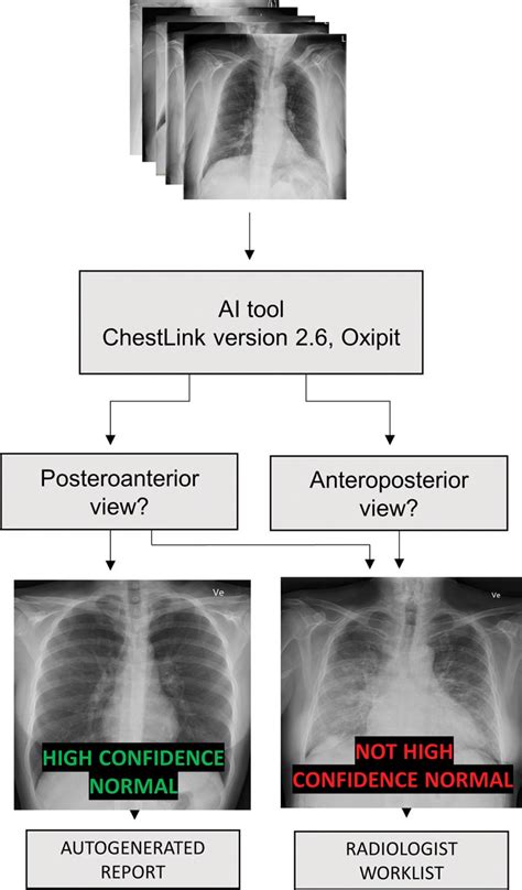 ai accurately identifies normal and abnormal chest x rays