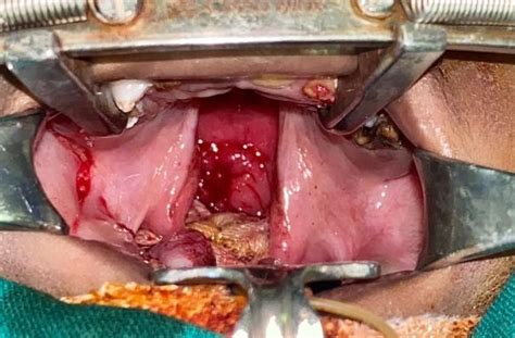 Secondary Cleft Palate Defect Download Scientific Diagram