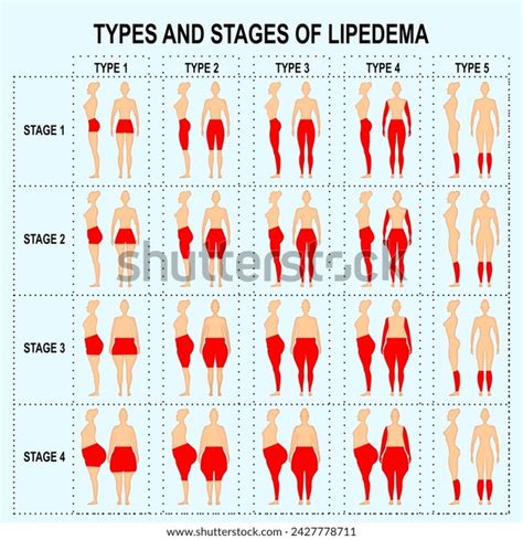 Types Stages Lipedema Medical Illustration Demonstration Stock