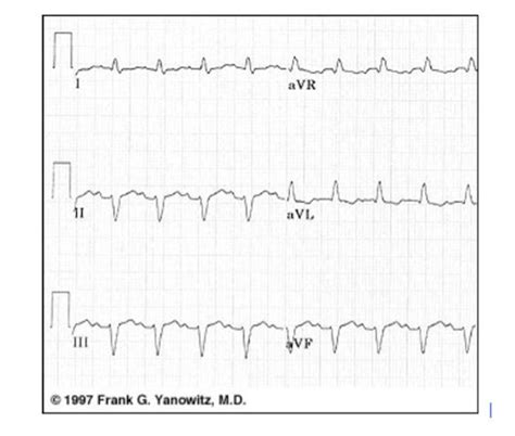 Determine The Mean Electrical Axis For The Ekg Below