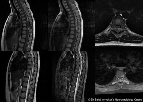 Dr Balaji Anvekar Frcr Ewings Sarcoma Mri Spine