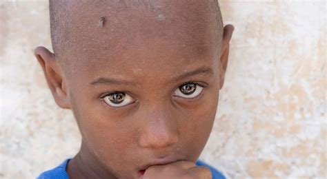 Marasmus Causes Symptoms Diagnosis And Treatment