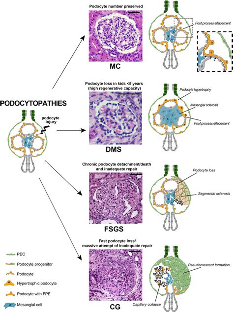 Frontiers The Pathology Lesion Patterns Of Podocytopathies How And Why
