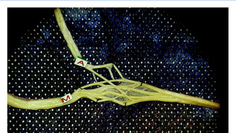 Figure 1 From Selective Neurotization Of The Median Nerve In The Arm To Treat Brachial Plexus