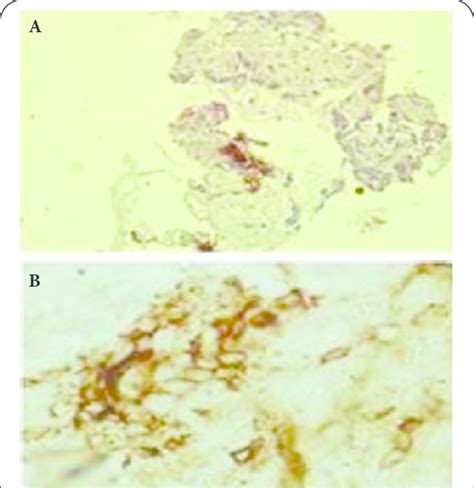 E Cadherin In The Basaloid Part Of The Basaloid Scc E Cadherin Of The Download Scientific