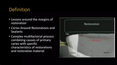 Secondarycariesoverviewandmanagementpdf