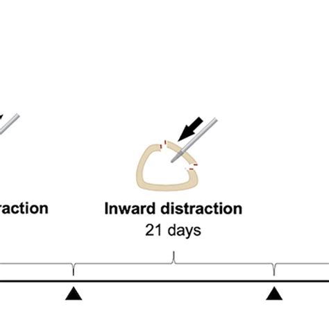 Schematic Drawing Of The Management For Tibial Cortex Transverse