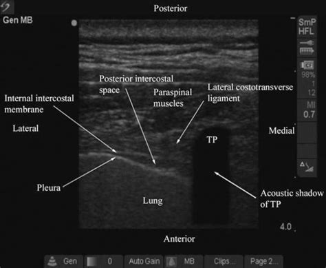 Ultrasound Guided Thoracic Paravertebral Block Nysora