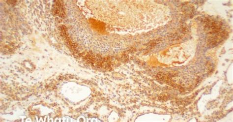 Glomus Tumour Pathology Stained With Sma X100 Image