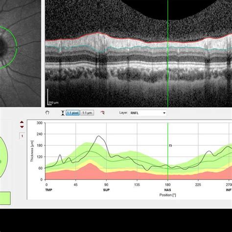 Scan Of The Rnfl Circle Structure The Image That Is Displayed In The