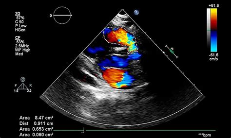 Color Duplex Ultrasound Venenclinic