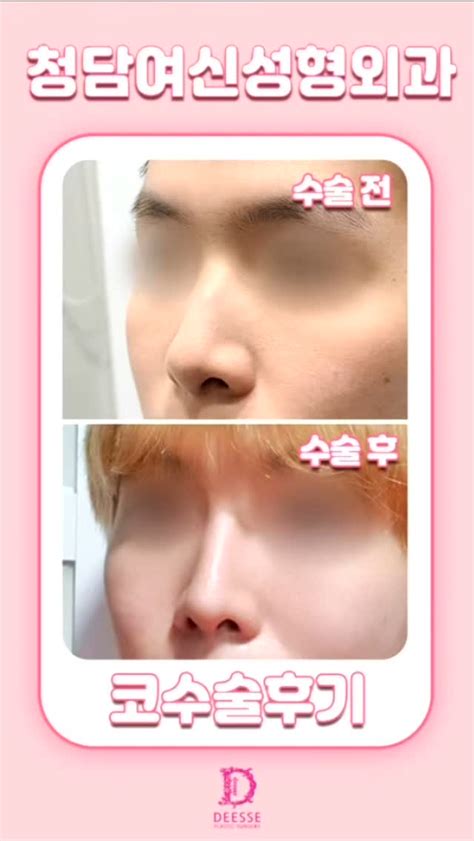 청담여신성형외과 코성형 입술성형 윤곽성형 눈성형 [리얼모델 모집 공고] 지원자격 만19세 이상 성인 남녀 수도권 거주가 우대 지원절차 모델신청