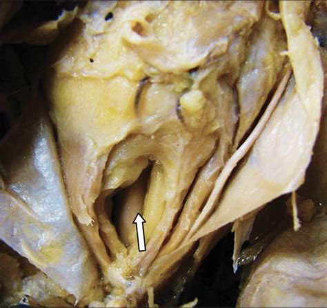 Superior View Of The Left Orbit With Optic Nerve Neuroanatomy The