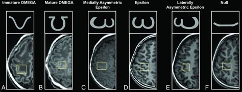 Morphologic Variants Of The Hand Motor Cortex In Developing Brains From