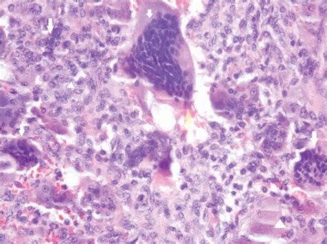 Oval And Spindle Mononuclear Cells Arrowhead And Clusters Of