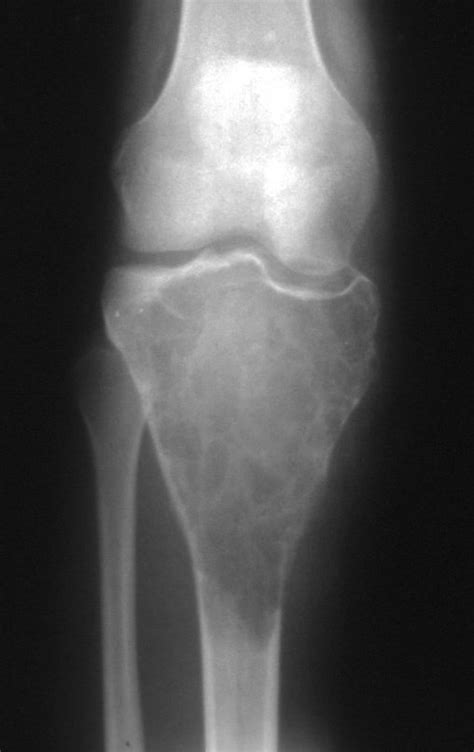Giant Cell Tumor Of The Tibia Oncosurgery