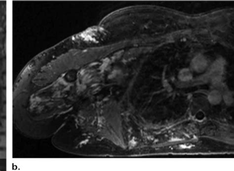 Blue Rubber Bleb Nevus Syndrome In A 32 Year Old Woman With