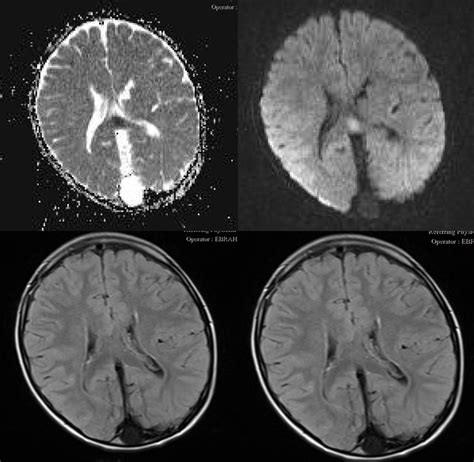 Transient Bilateral Blindness Due To Mild Encephalopathy With