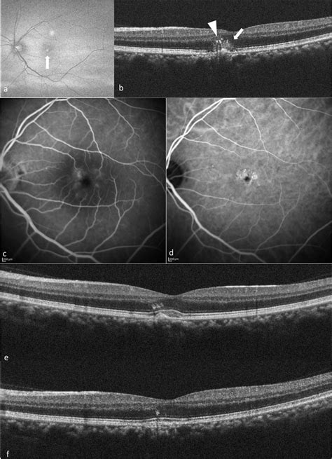 Multimodal Imaging Of Case 1 A A 47 Year Old Man Presented To A